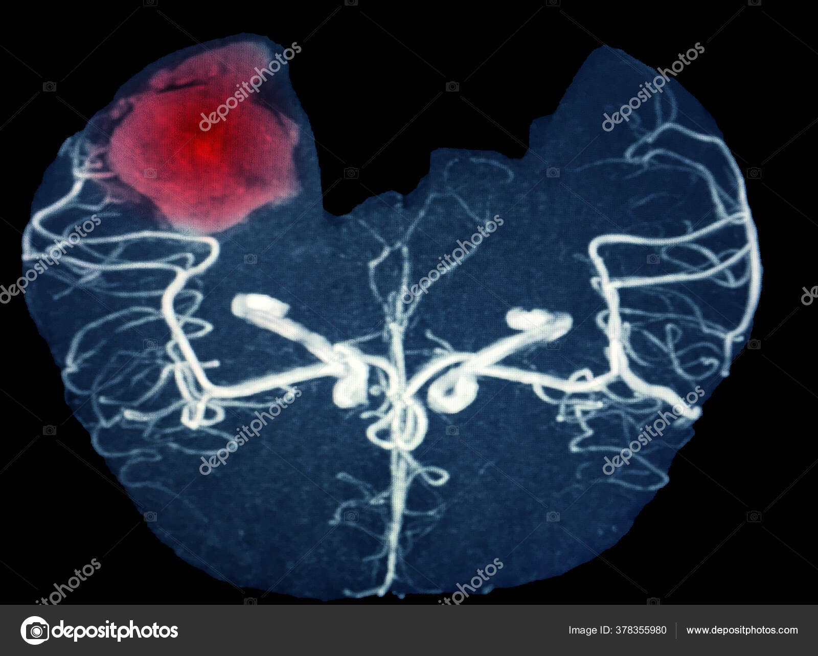 Imagem Angiografia Por Ressonância Magnética Arm Artéria Cerebral ...