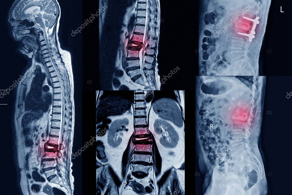 Ressonancia Magnetica Da Coluna Osteoma Osteoide