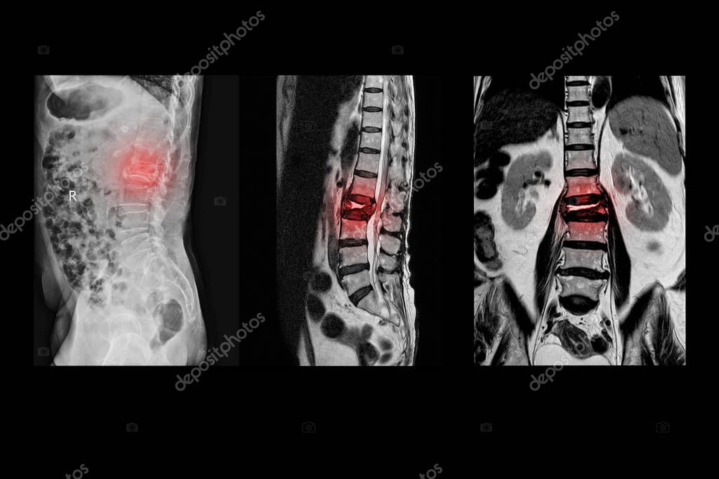 Resonancia magnética de la columna lumbar Antecedentes de caída con ...