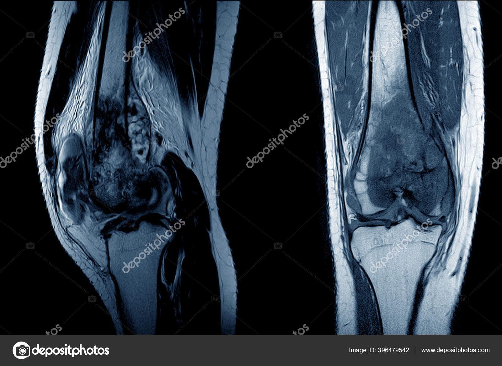 Mri Knee Joint Lateral Views Female Year Old Showing