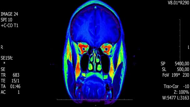 Real life man brain mri scan with tumor neoplasm medical reseach new ...