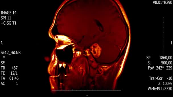 Real life man brain mri scan with tumor neoplasm medical reseach new ...