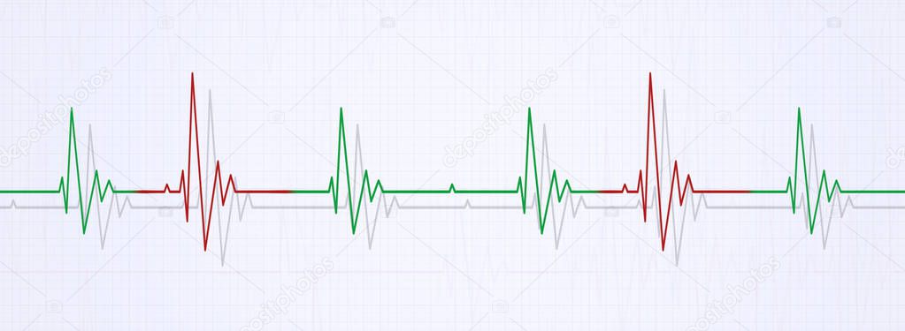 latidos irregulares del corazón en ecg 2024