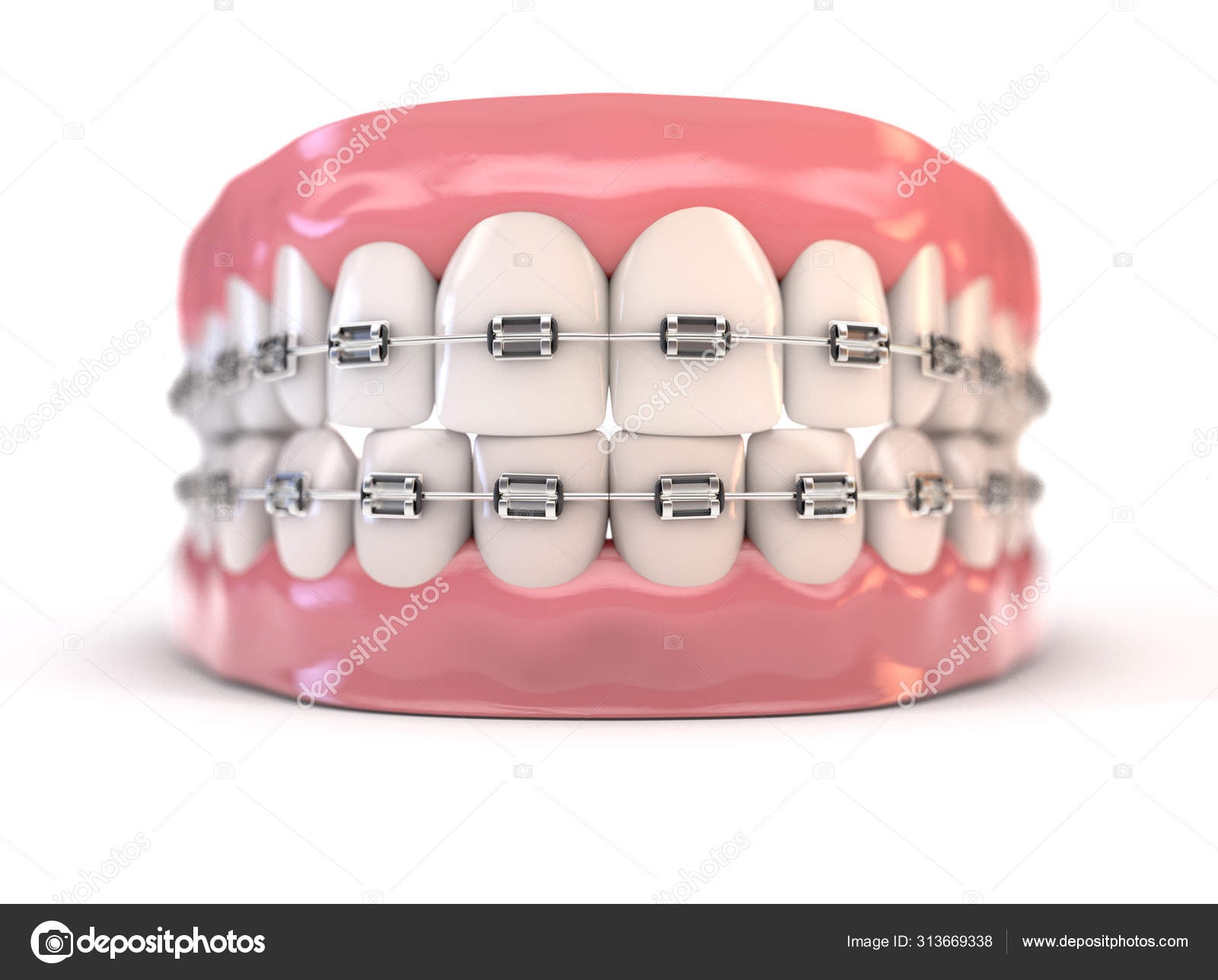Fake Teeth Set With Braces Stock Photo by ©albund 313669338