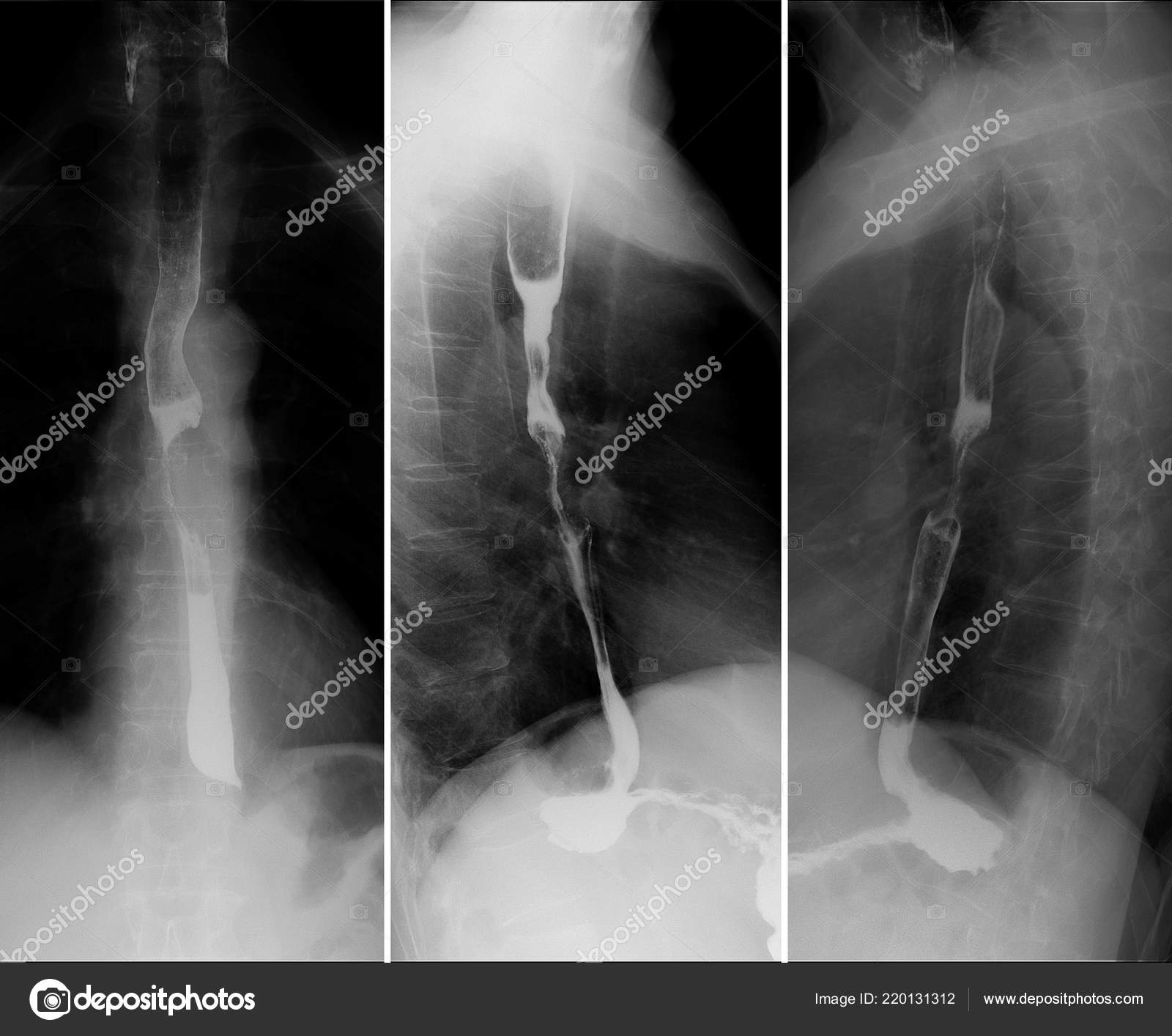 Xray Of The Upper Gastrointestinal Series Ugi With Barium X Ray Upper