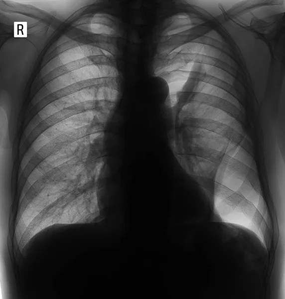 X-ray lungs: Lobectomy of the upper lobe of the left lung post cancer ...