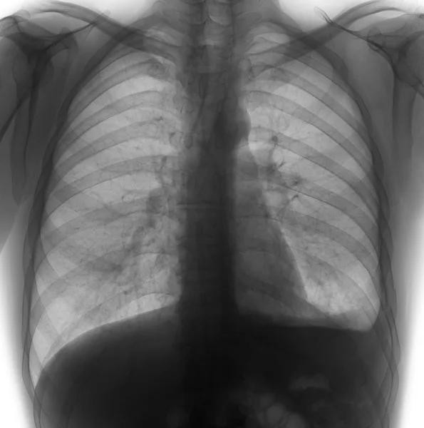 X-ray lungs: Lobectomy of the upper lobe of the left lung post cancer ...