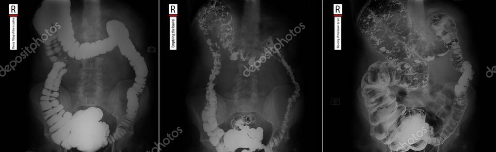 Radiografía de las partes inferiores del tracto gastrointestinal (GI ...