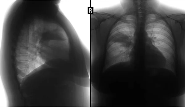 X-ray lungs: Lobectomy of the upper lobe of the left lung post cancer ...