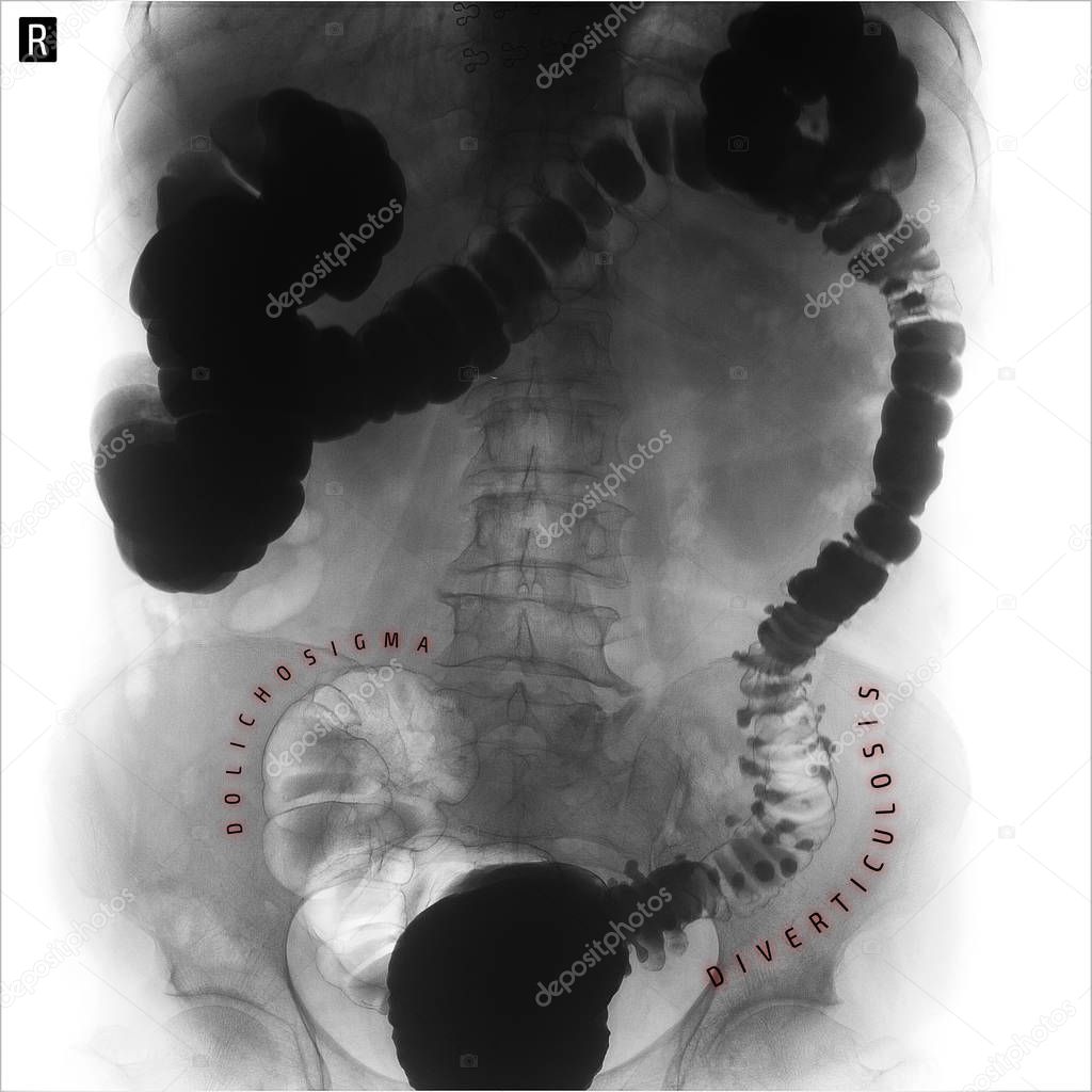 Radiografía de las partes inferiores del tracto gastrointestinal (GI ...