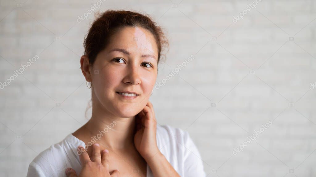 Vitiligo. Retrato de una hermosa mujer sonriente con falta de ...
