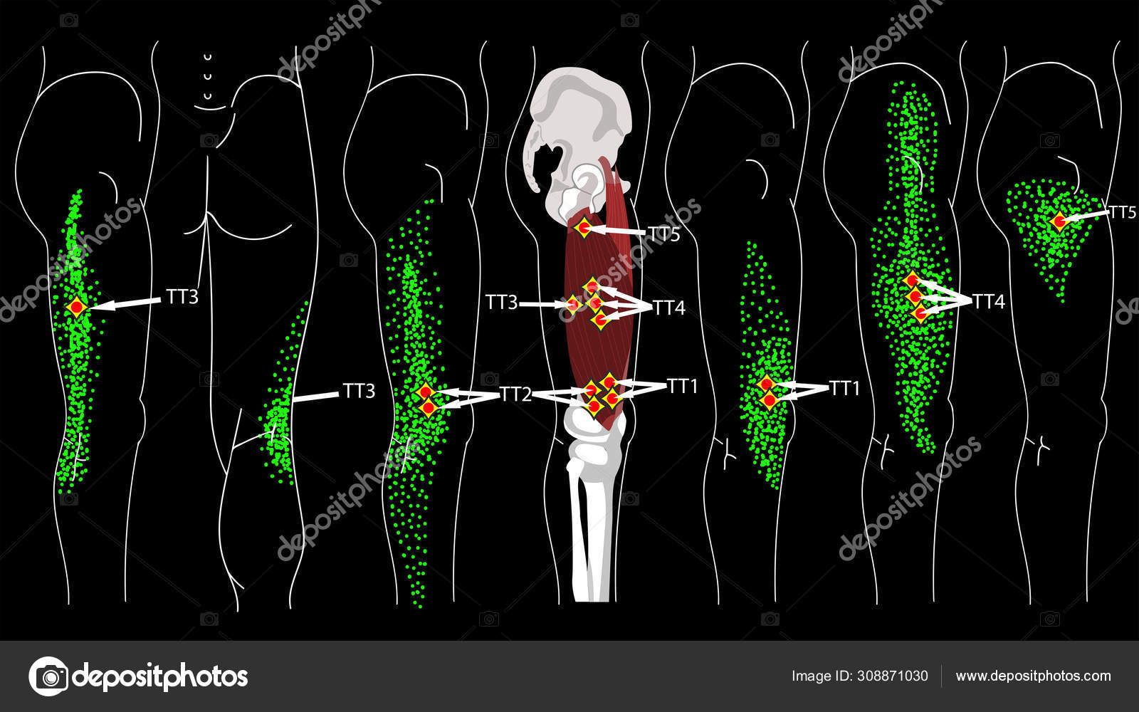 Vastus Lateralis Trigger Points. Leg pain. Release Stock Vector Image ...