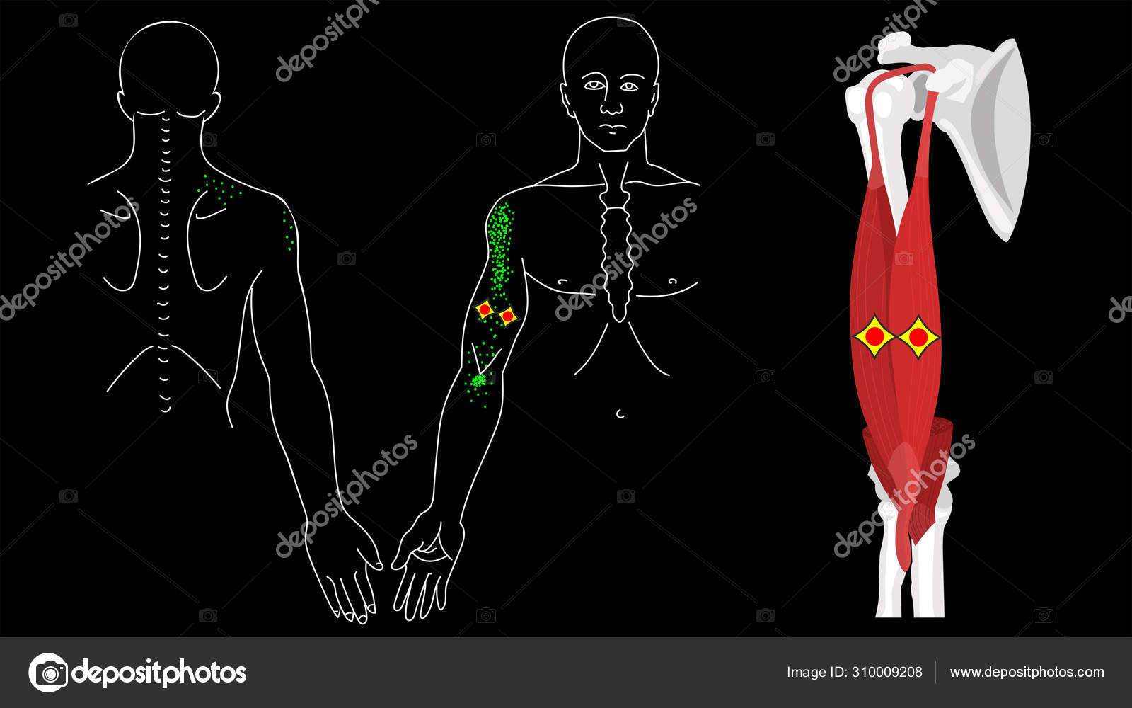 Musculus biceps brachii. Biceps trigger points and pain Stock Vector ...