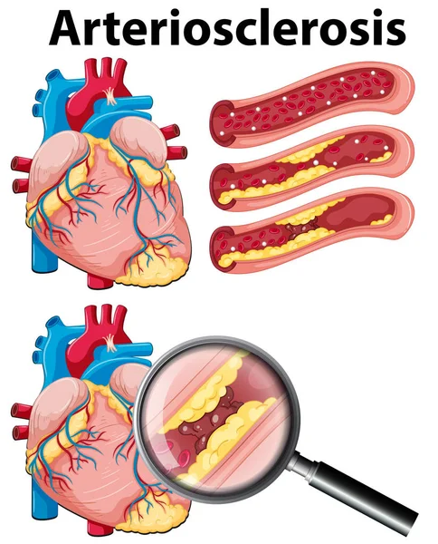 Arteriosclerosis Vector Art Stock Images | Depositphotos