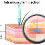 Intramuscular injection vector illustration. Technique of intramuscular ...