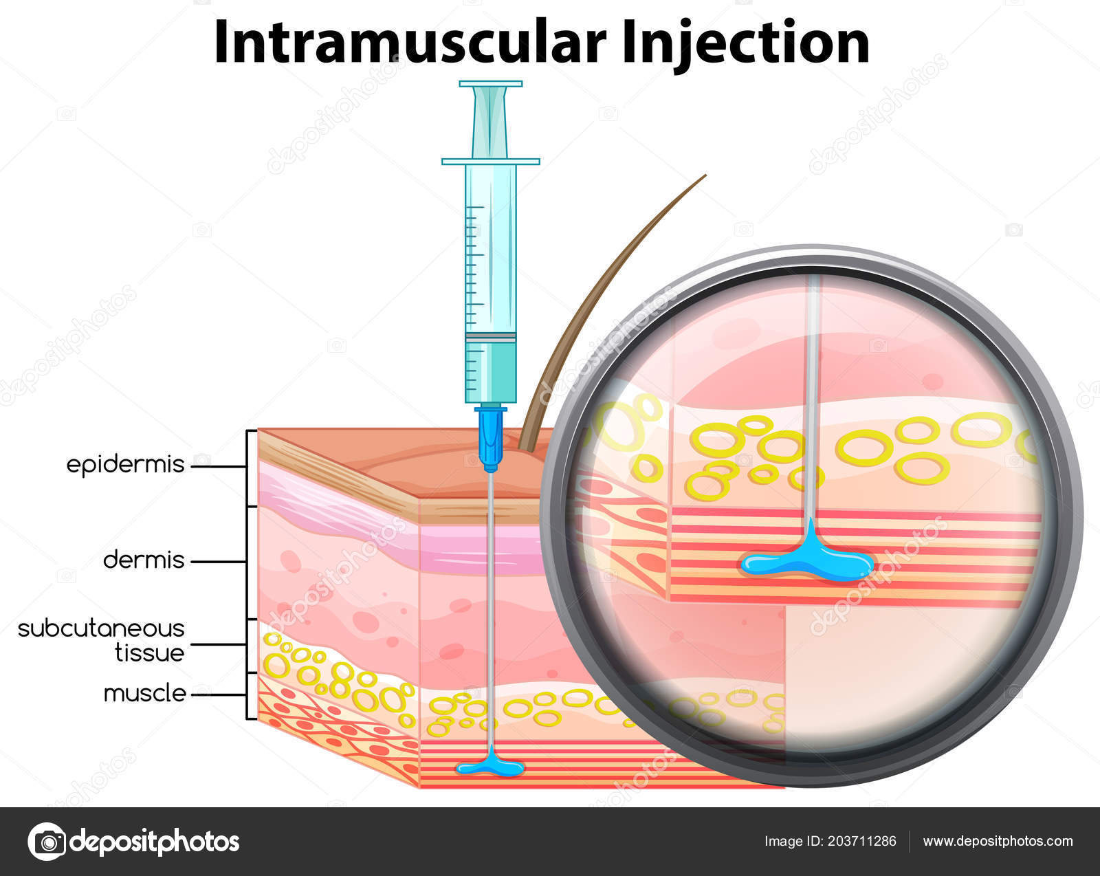Ilustração Intramuscular Injeção Pele Humana — Vetor de Stock ...