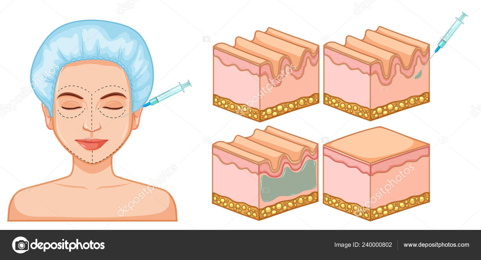 Lady Facial Skin Botox Illustration Stock Vector Image by ...