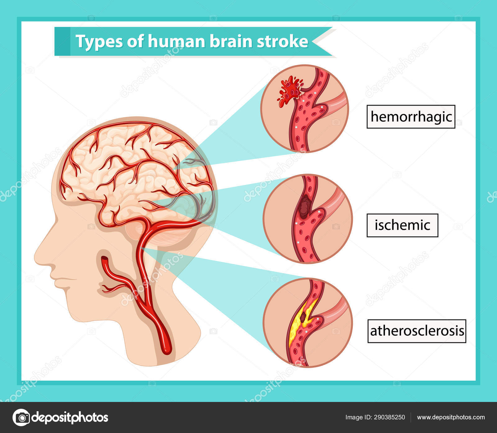 Scientific Medical Illustration Of Human Brain Stroke Stock Vector
