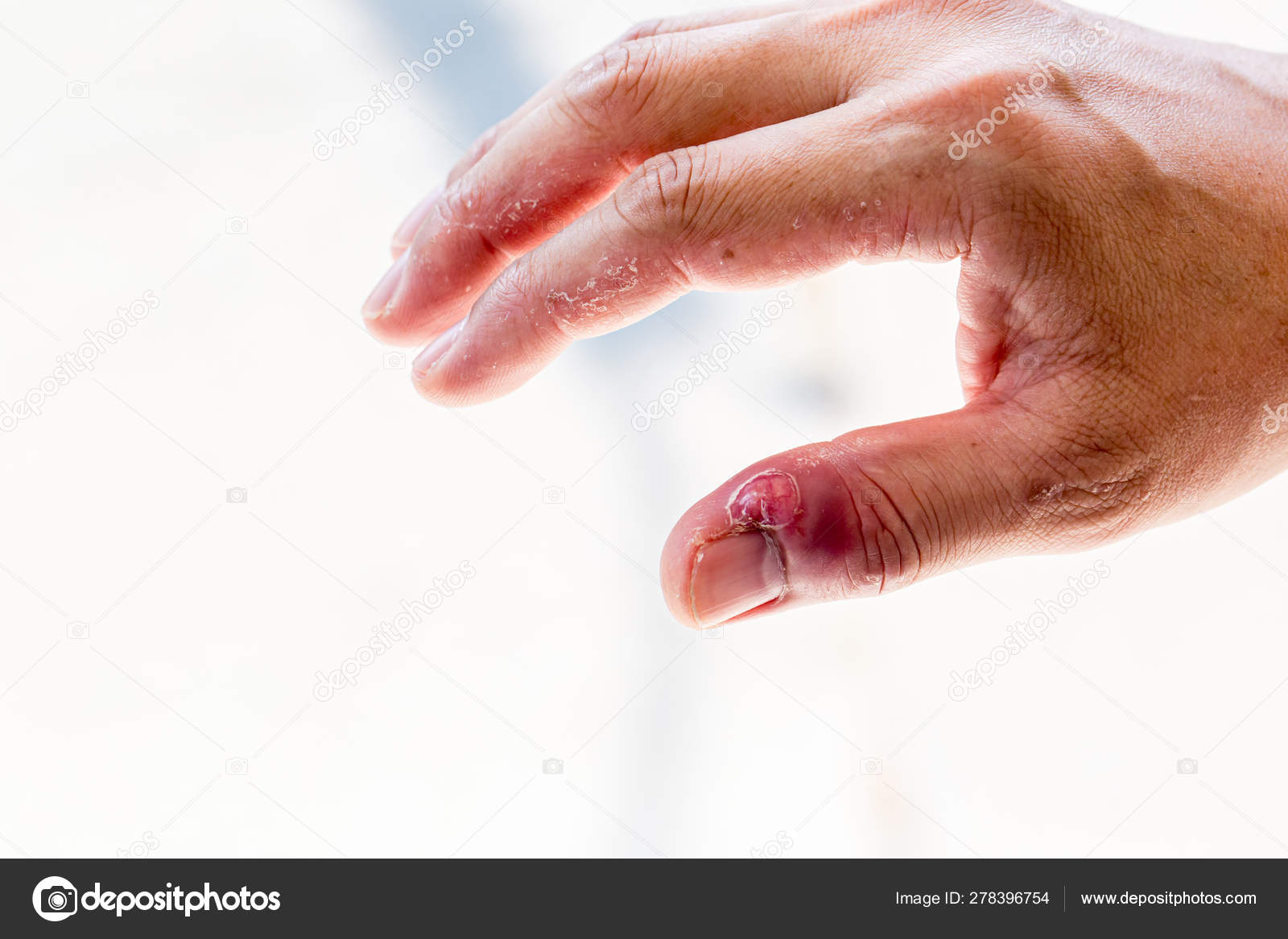 Paronychia Swollen Finger Fingernail Bed Inflammation Due Bacterial ...