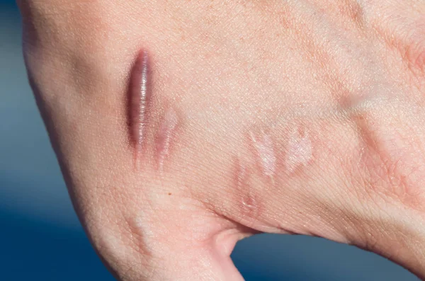 Keloid scar (Hypertrophic Scar) on man hand skin after accident ...