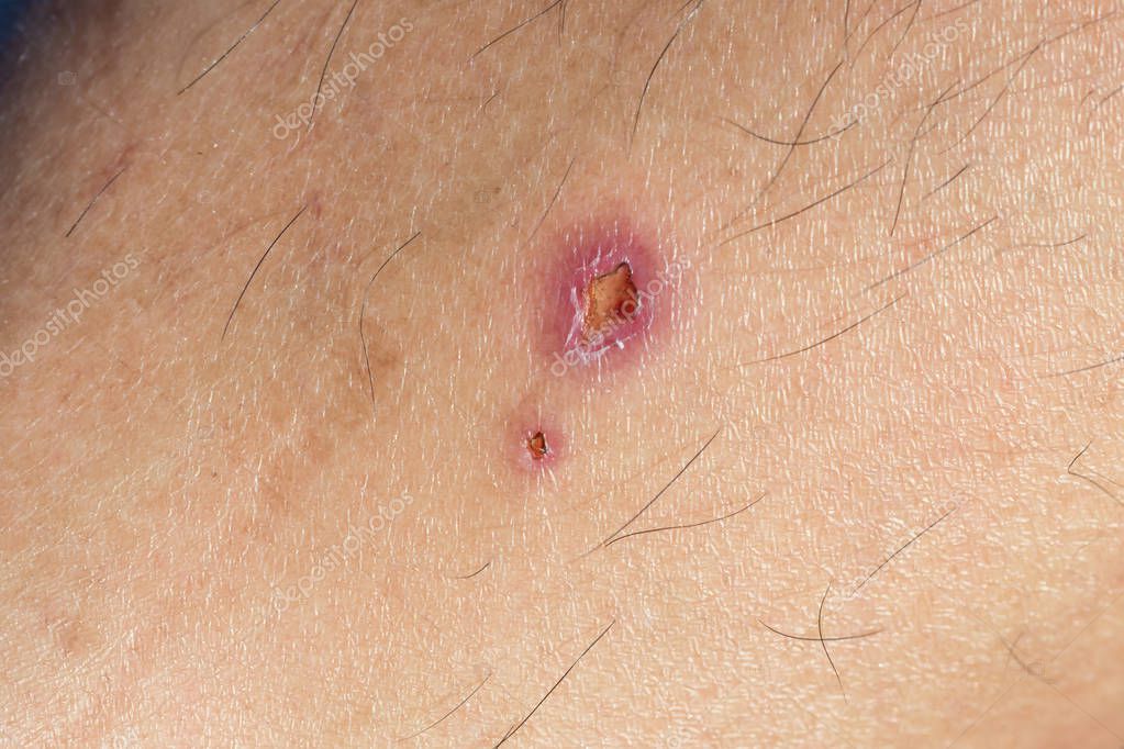 Infección de heridas en la piel. Una herida en el cuerpo humano, sutura ...