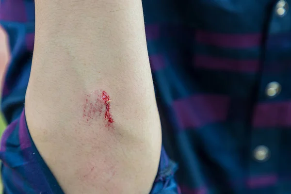 Ferida do cotovelo Stock Photos, Royalty Free Ferida do cotovelo Images ...