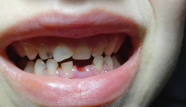 Child chipped teeth Stock Photos, Royalty Free Child chipped teeth ...