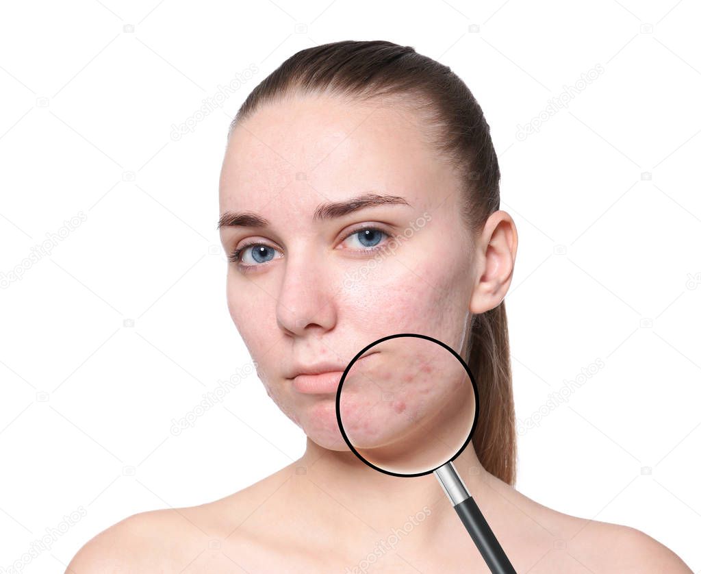 Ampliar la piel de la mujer joven con el problema del acné en el fondo ...