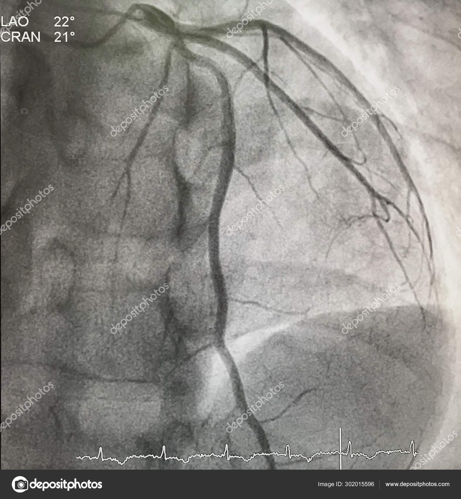 Normal Left Circumflex Coronary Artery Cine Lao Caudal View Ray Stock ...
