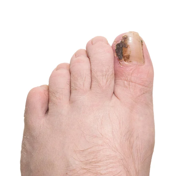 Toe amputation Stock Photos, Royalty Free Toe amputation Images ...