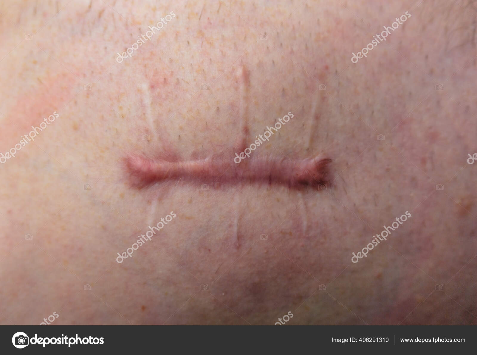 Wounded Human Body Suture Protracted Old Deep Cut Scar Close — Stock ...