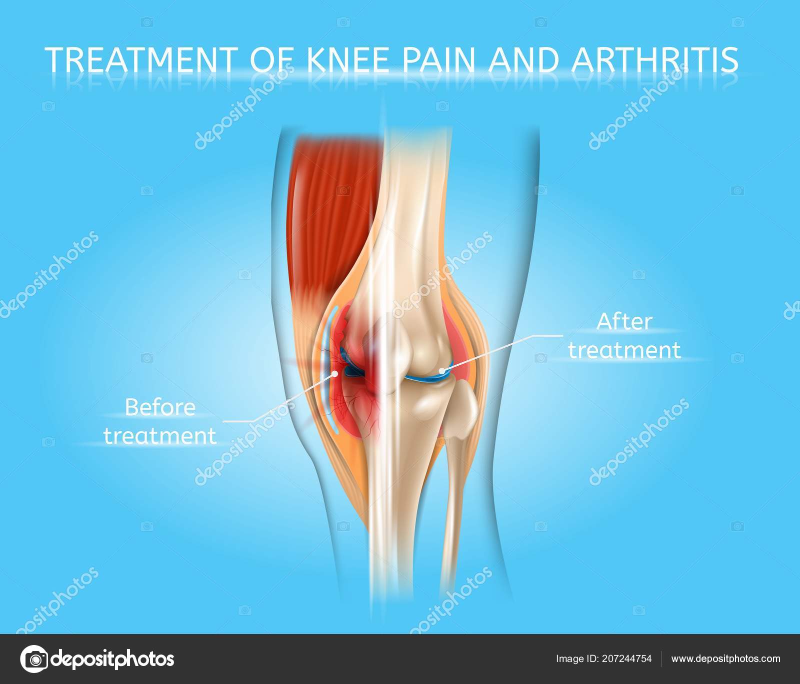 Knee Pain and Arthritis Treatment Vector Chart Stock Vector by ...