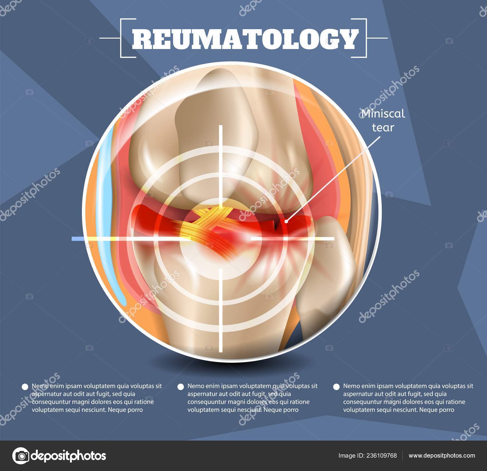 Ilustración realista Reumatología Medicina en 3D Vector de stock por ...