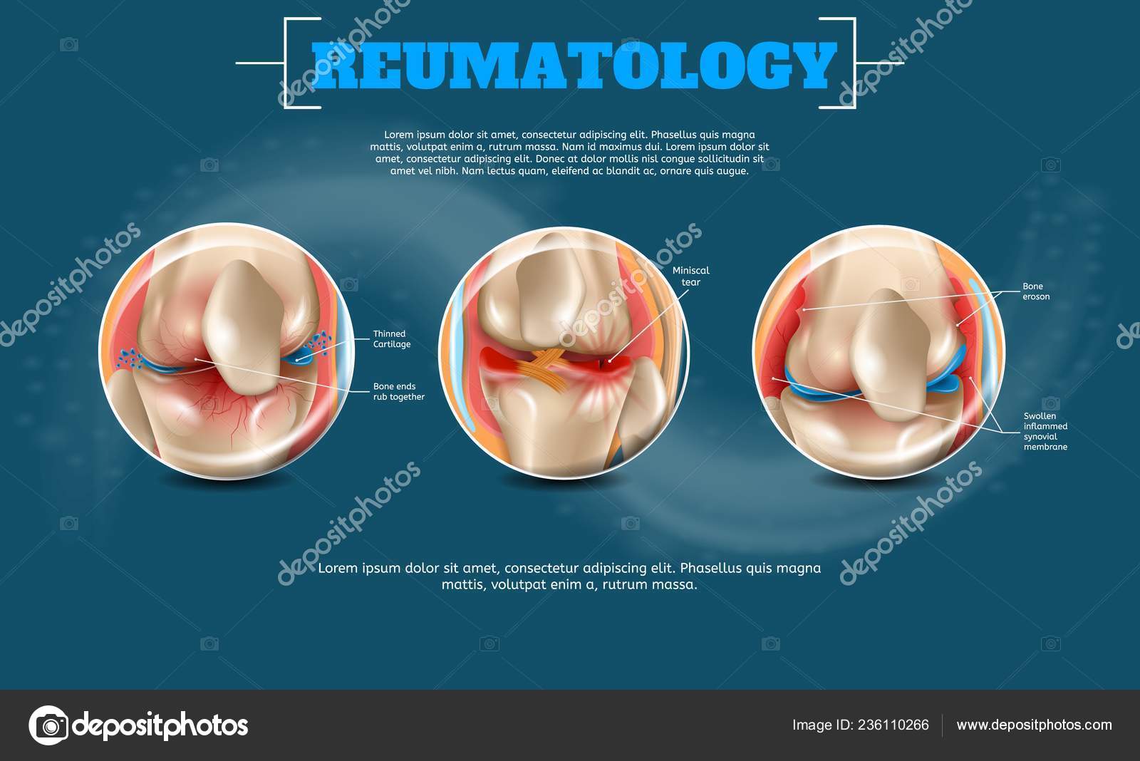 Realista Banner Ilustración Reumatología Vector Vector de stock ...