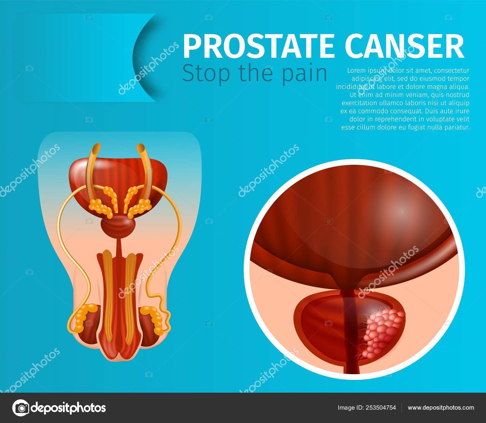Image vectorielle Cellules cancéreuses de tumeur dans la bannière de glande de prostate par ...
