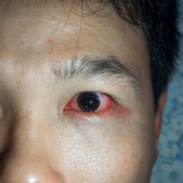 Dengue rash photo Stock Photos, Royalty Free Dengue rash photo Images ...