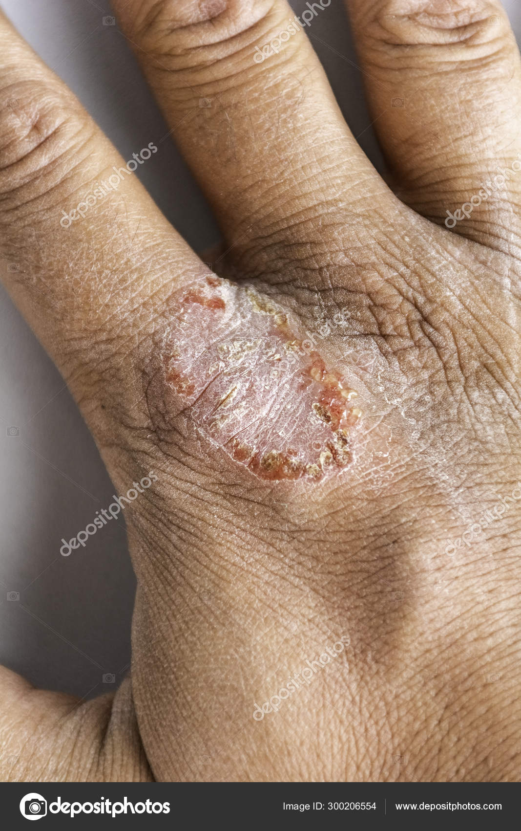 Hand With Atopic Dermatitis Eczema Psoriasis Vulgaris Stock Photo by ...