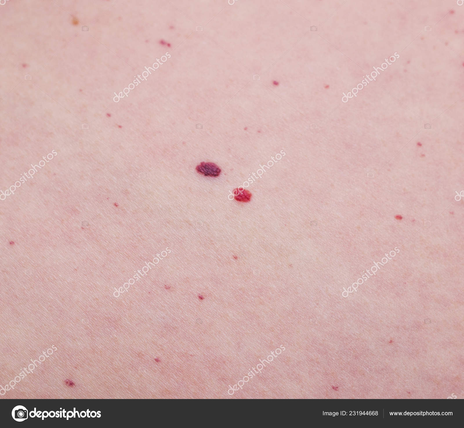 Hémangiome, microhématome sur la peau humaine, gros plan, maladie image ...