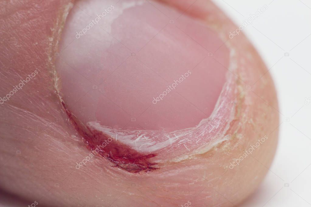 Mal hábito, uñas rotas, uñas arrancadas, cutícula y sangre, dedo macro ...