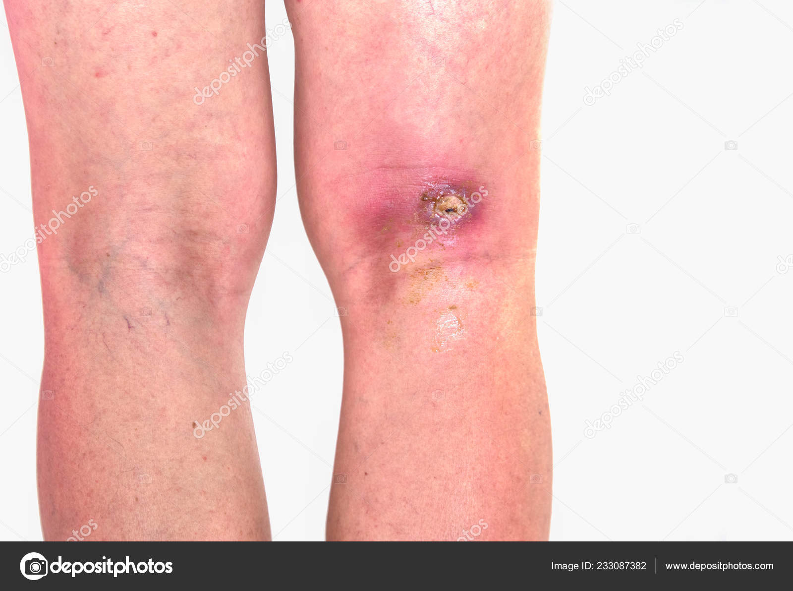 Abcess Popiteal Area Inflammation Popiteal Zone Right Leg Infected ...