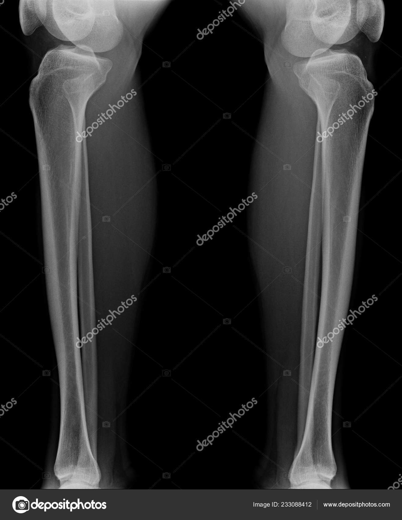 A The Radiograph Of Left Tibia And Fibula Shaft Open