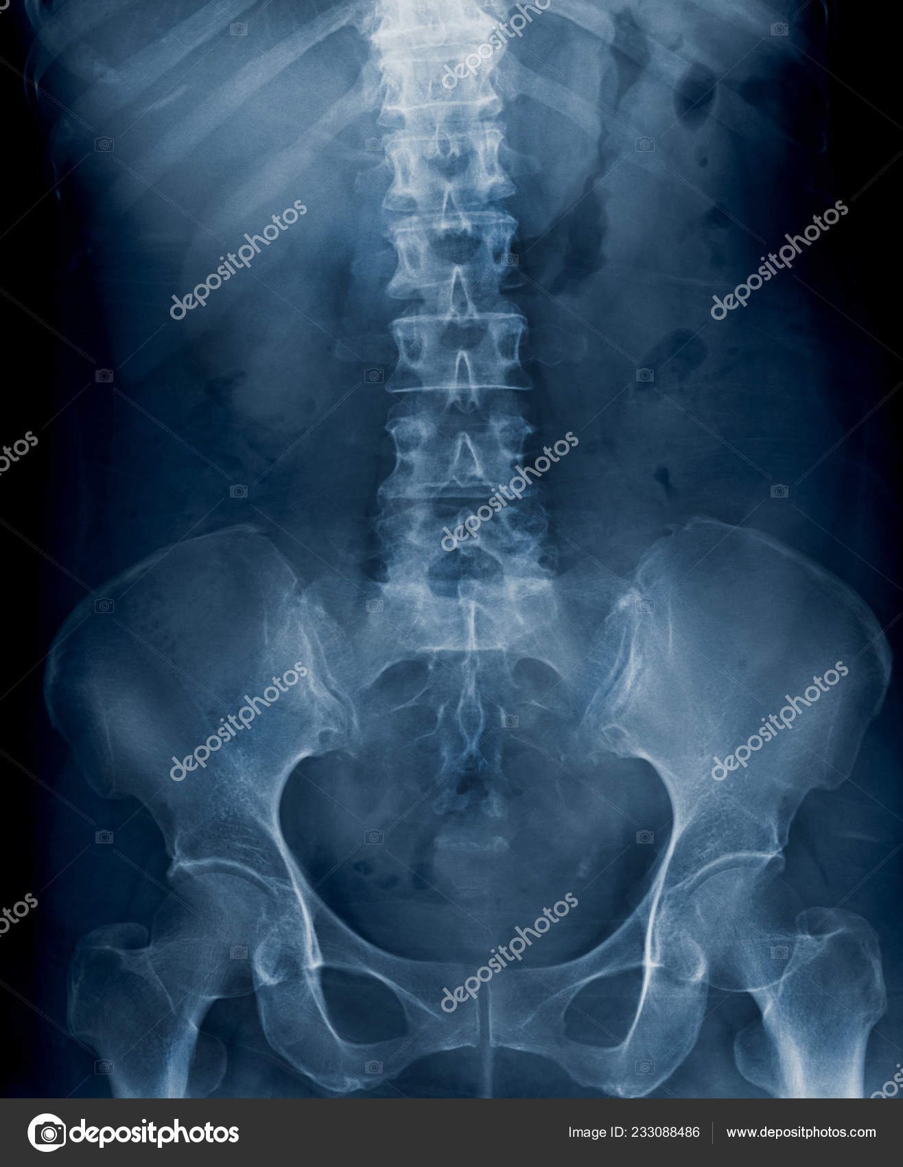 Ray Lumbar Spine Show Lumbar Spondylosis Degenertive Change Disc Body ...