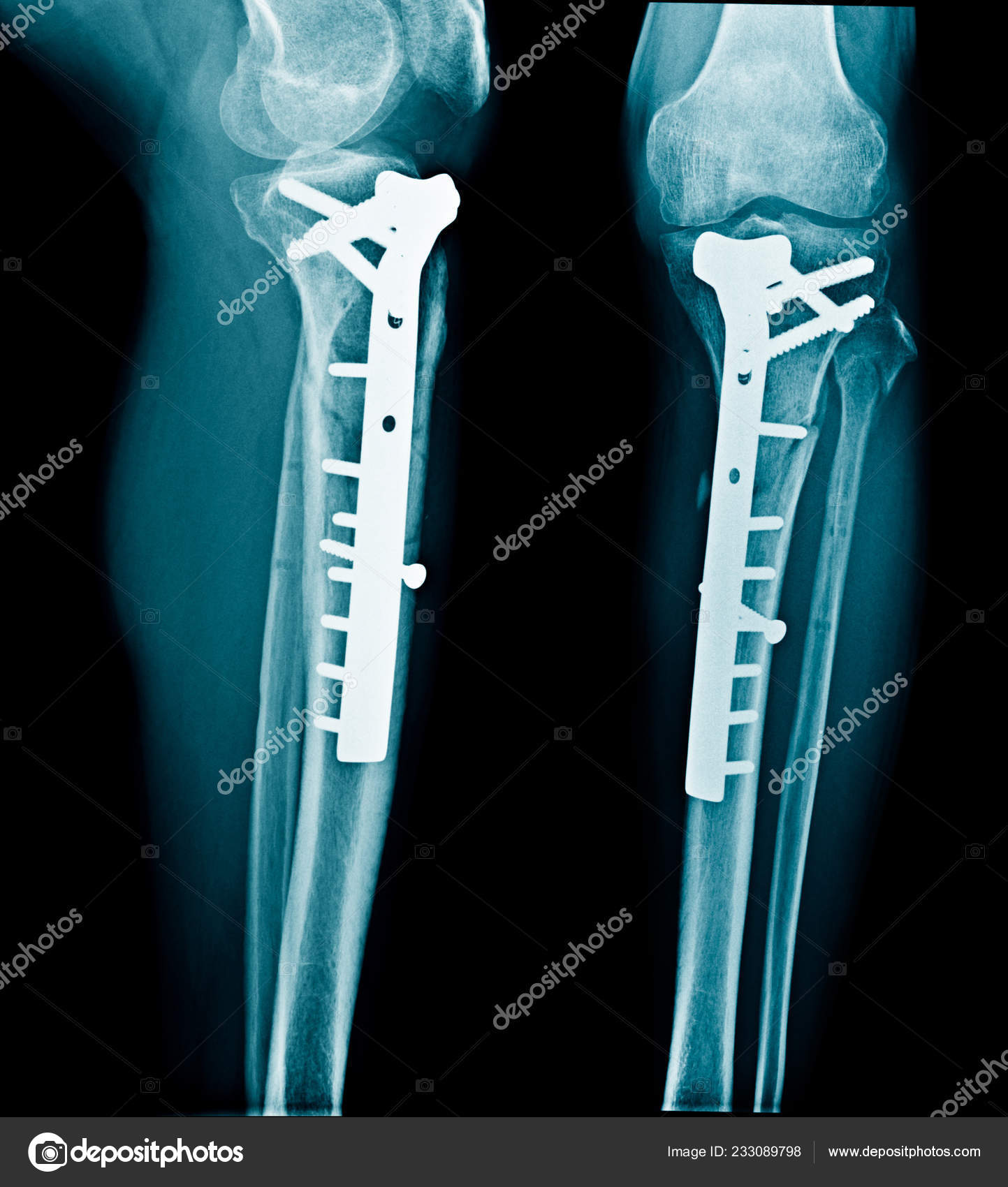 Anatomía De La Tibia Proximal