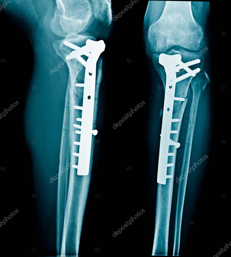 imagen de rayos X fijación interna tibia proximal 2023