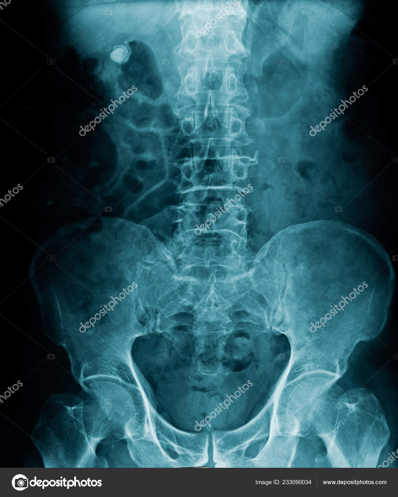 High Quality Ray Human Spine Show Degenerative Change Lumbar Spine ...