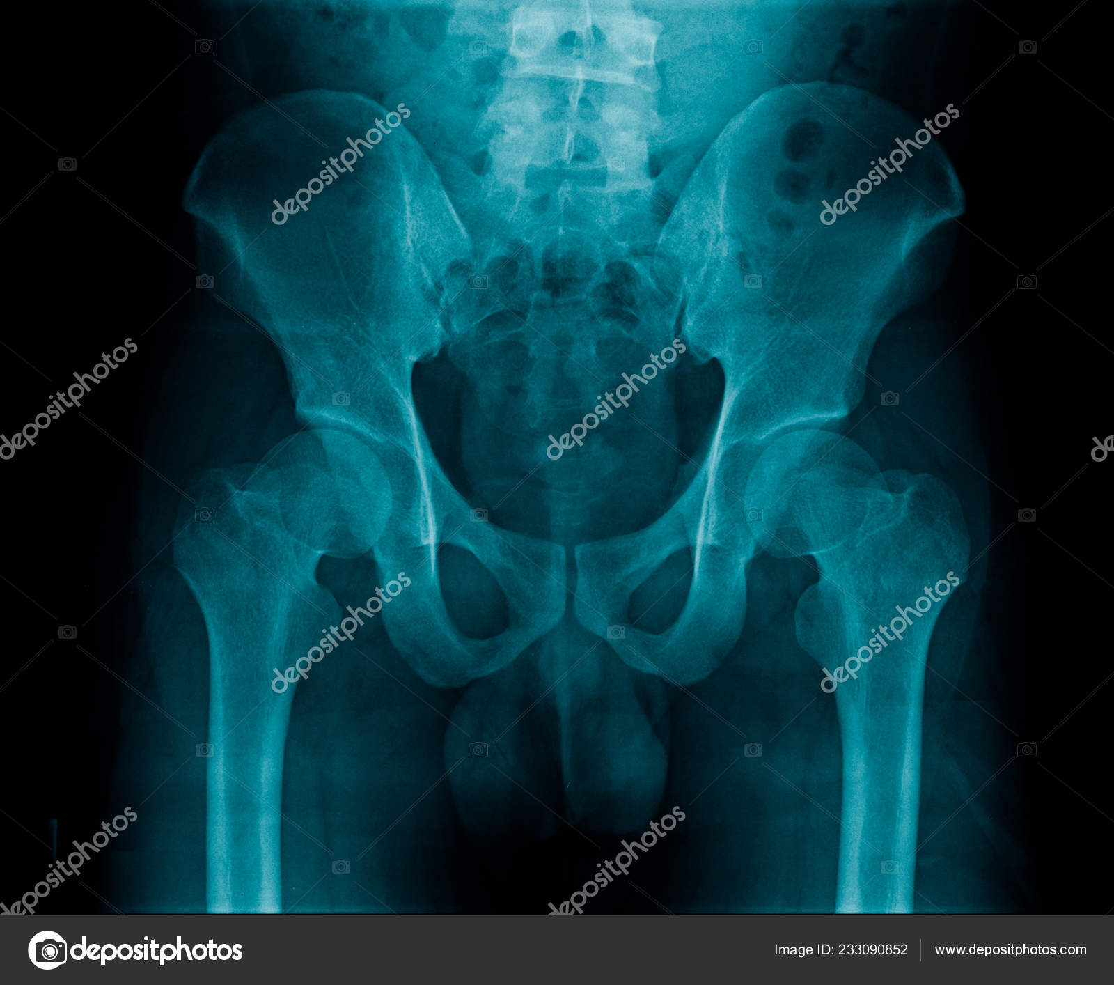 Degenerative Change Hip Joint Old Man Pain Hip Joint Ray Stock Photo by ...