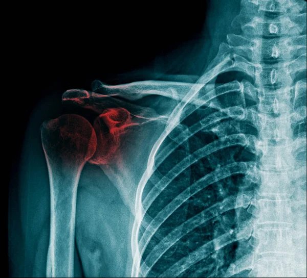Shoulder fracture Stock Photos, Royalty Free Shoulder fracture Images ...