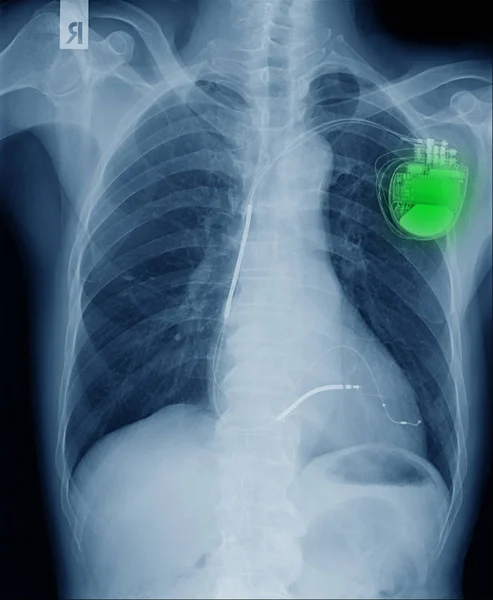Chest Ray Ray Image Human Chest Pacemaker Placement Cardiac Pacemakers ...
