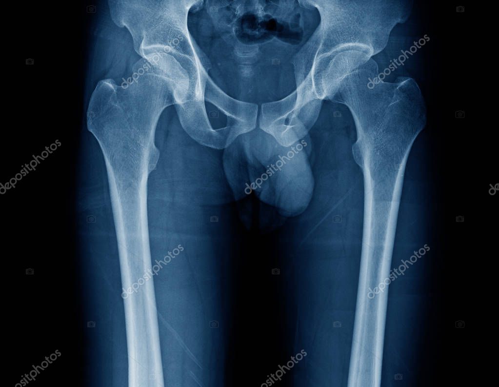 radiografía de alta calidad de la articulación de la cadera y el fémur ...