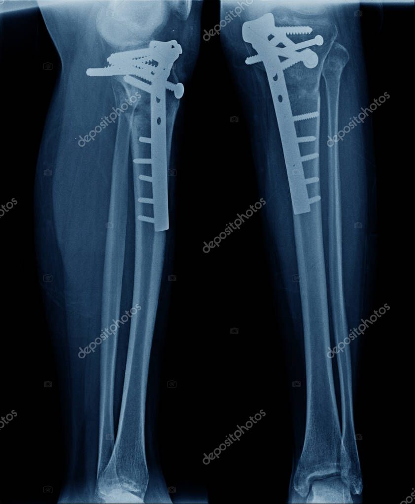 La imagen de rayos X de la pierna muestra la fijación ósea de la tibia ...